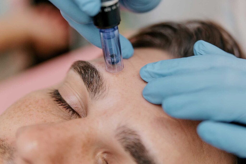 #1 Microneedling Treatments Rhode Island